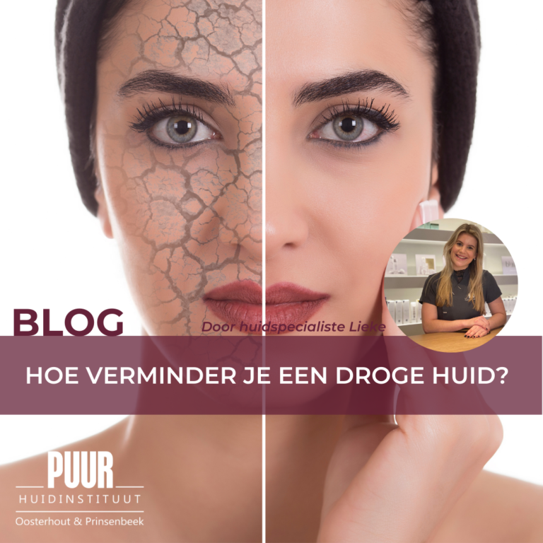 Hoe Verminder Je Een Droge Huid ? Hoe Verminder Je Een Droge Huid ...